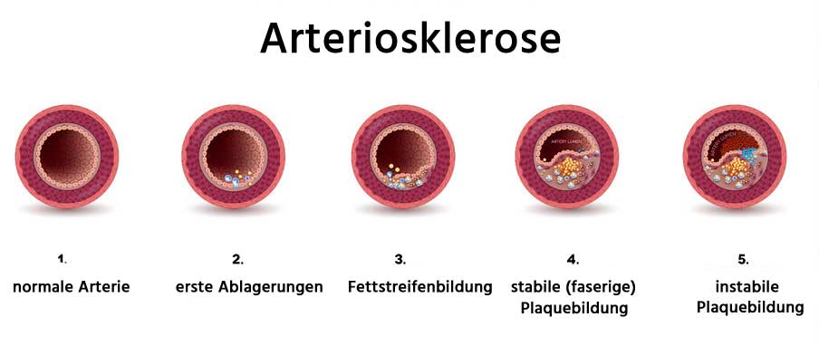 ᐅ Was ist Arteriosklerose (Arterienverkalkung)? Symptome, Warnsignale